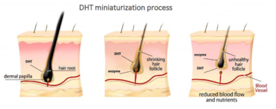 Hair Restoration - Coquitlam Medical Laser|SculpSure Body Contouring